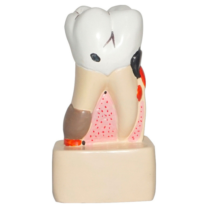 4 Times Teeth Periodontal Disease Models human teeth model medical ...