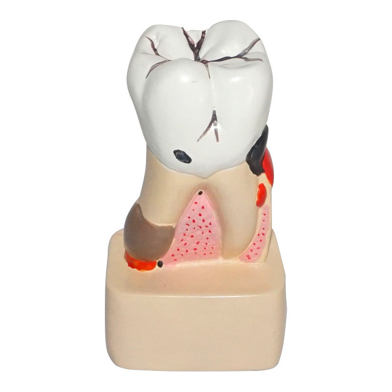 4 Times Teeth Periodontal Disease Models human teeth model medical ...