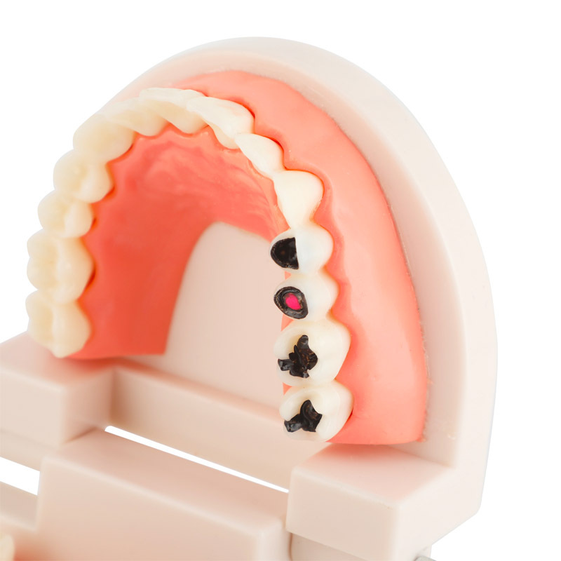 1:1 Artificial Teeth Dental Model for Decayed Teeth, Demonstration ...